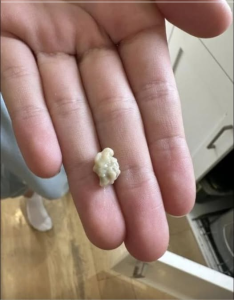 Understanding Tonsil Stones: Why This Common Condition Is Suddenly ...